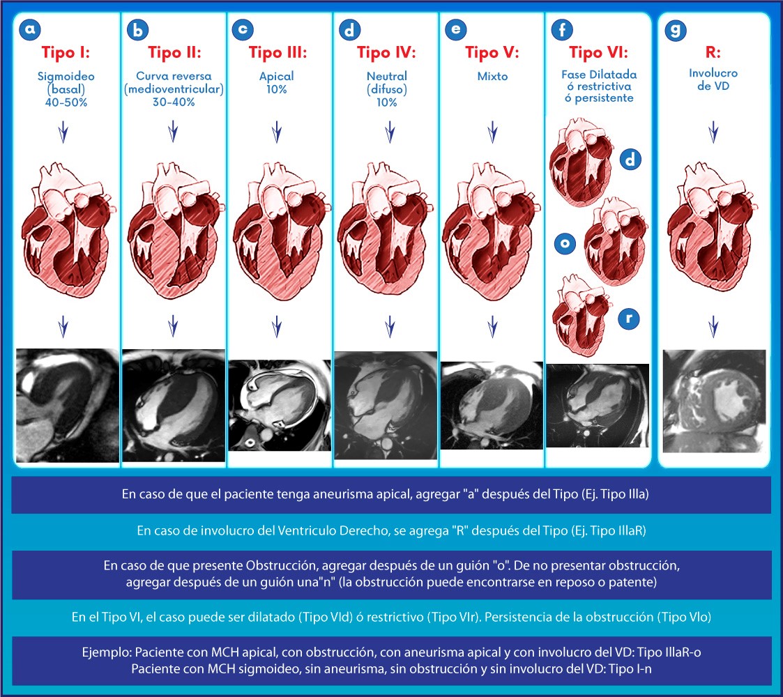 Hypertrophic cardiomyopathy. Proposal for a new classification